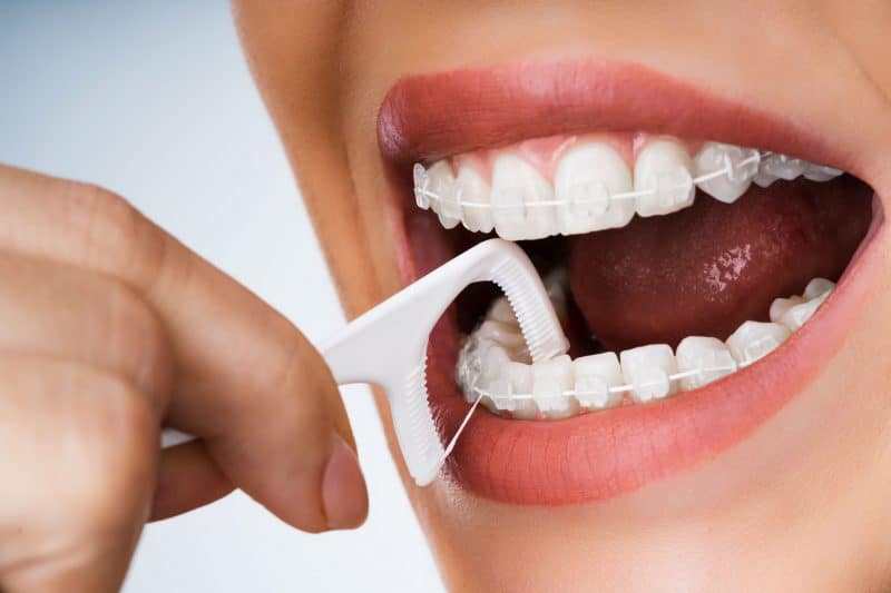 Straightening Your Smile: Essential Tips for Caring for Your Braces