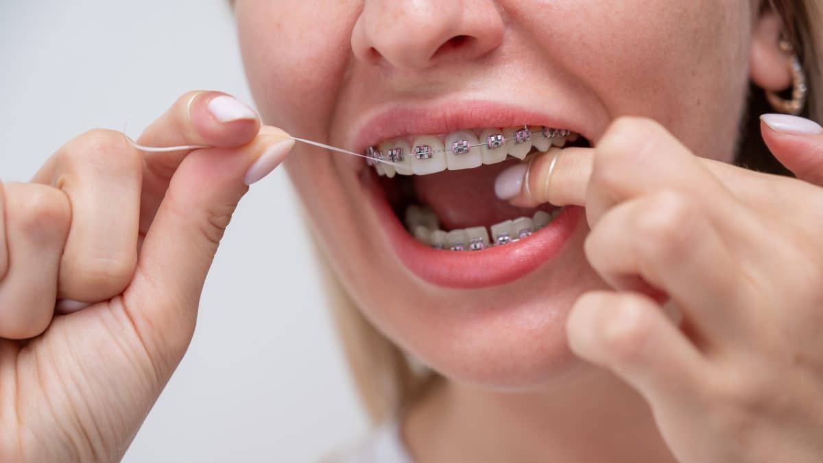 Guide to Flossing with Braces: Methods, Tips, and More for Optimal Oral ...