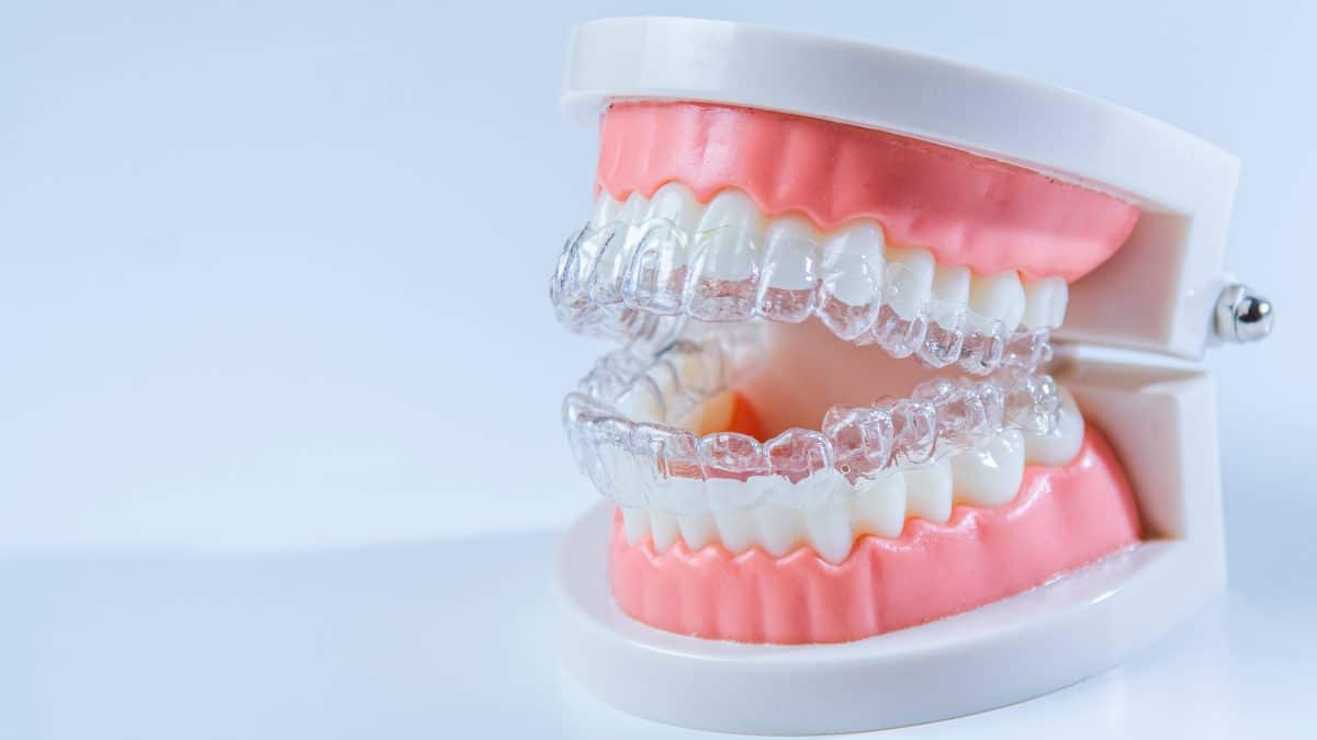 What Is an Essix Retainer? Benefits, Care, and Usage Explained