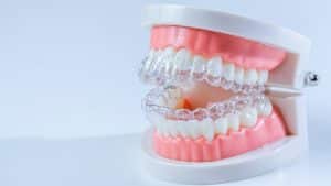 What Is an Essix Retainer? Benefits, Care, and Usage Explained